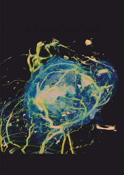 Sugar makes cancer light-up in MRI scanners | Science Codex