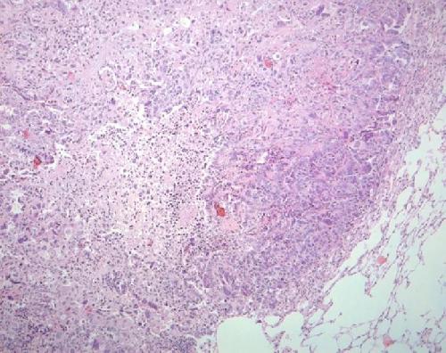 The CNIO finds a potential therapy for the most aggressive type of lung ...