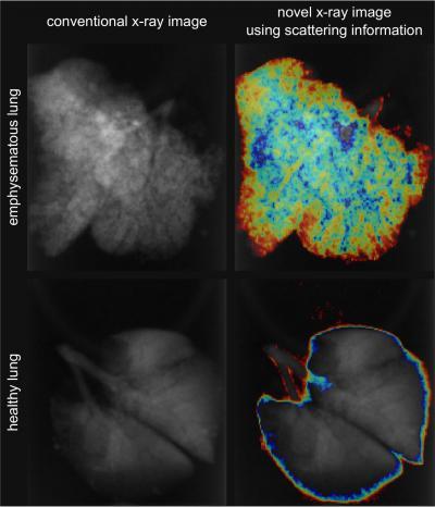 Scattered X-rays reveal diseased tissue | Science Codex